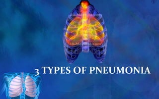 Pneumonia | PPTX