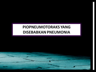 Pneumonia | PPT