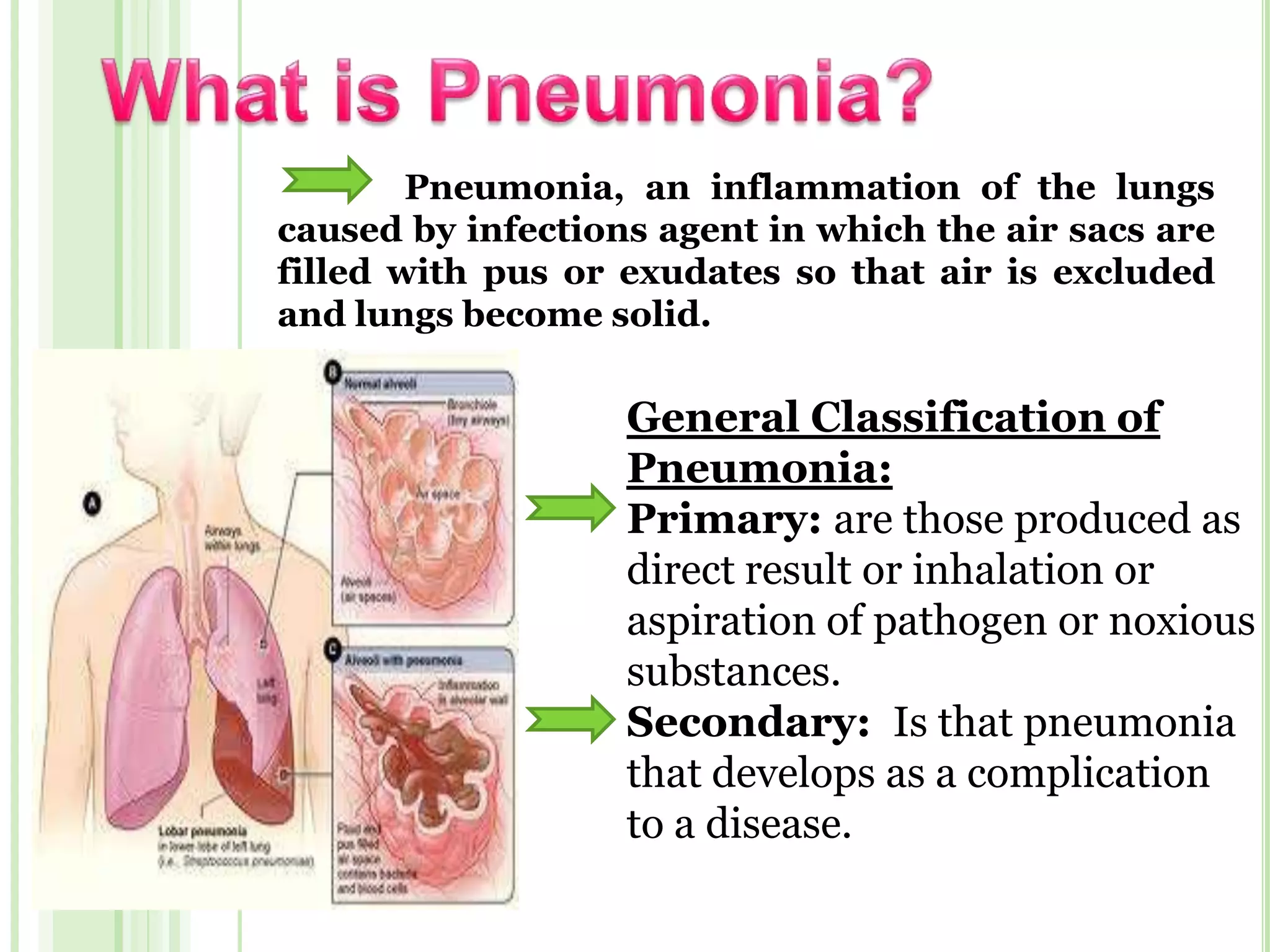 Pneumonia | PPTX