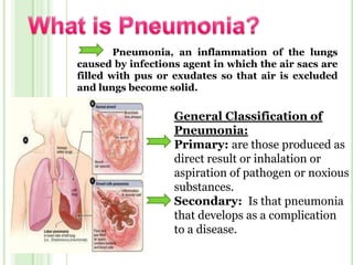 Pneumonia | PPTX