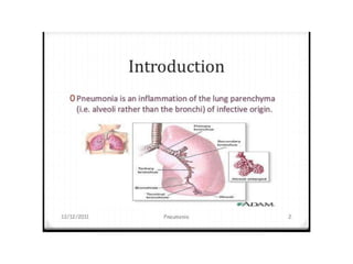 Pneumonia | PPTX