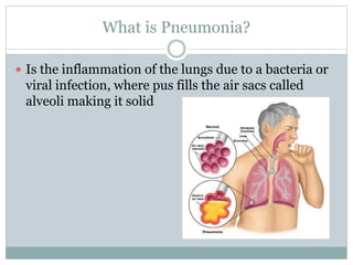 Pneumonia | PPTX