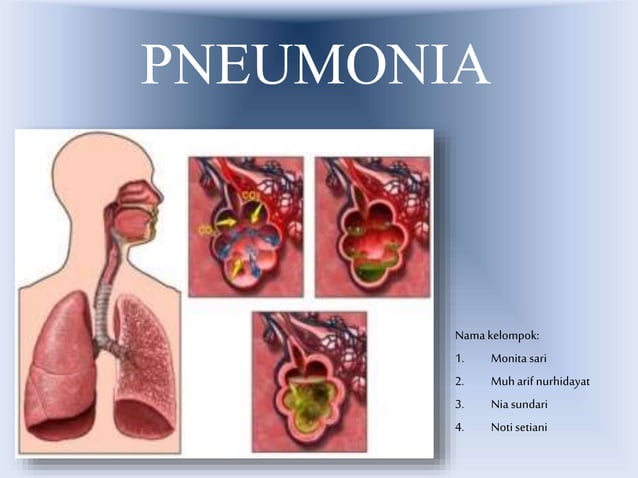 Pneumonia | PPTX