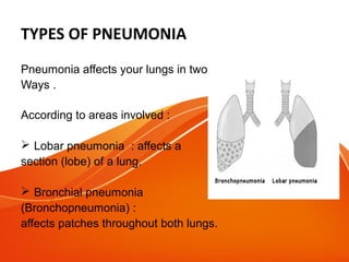 Pneumonia | PPT