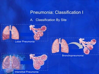 Pneumonia | PPTX