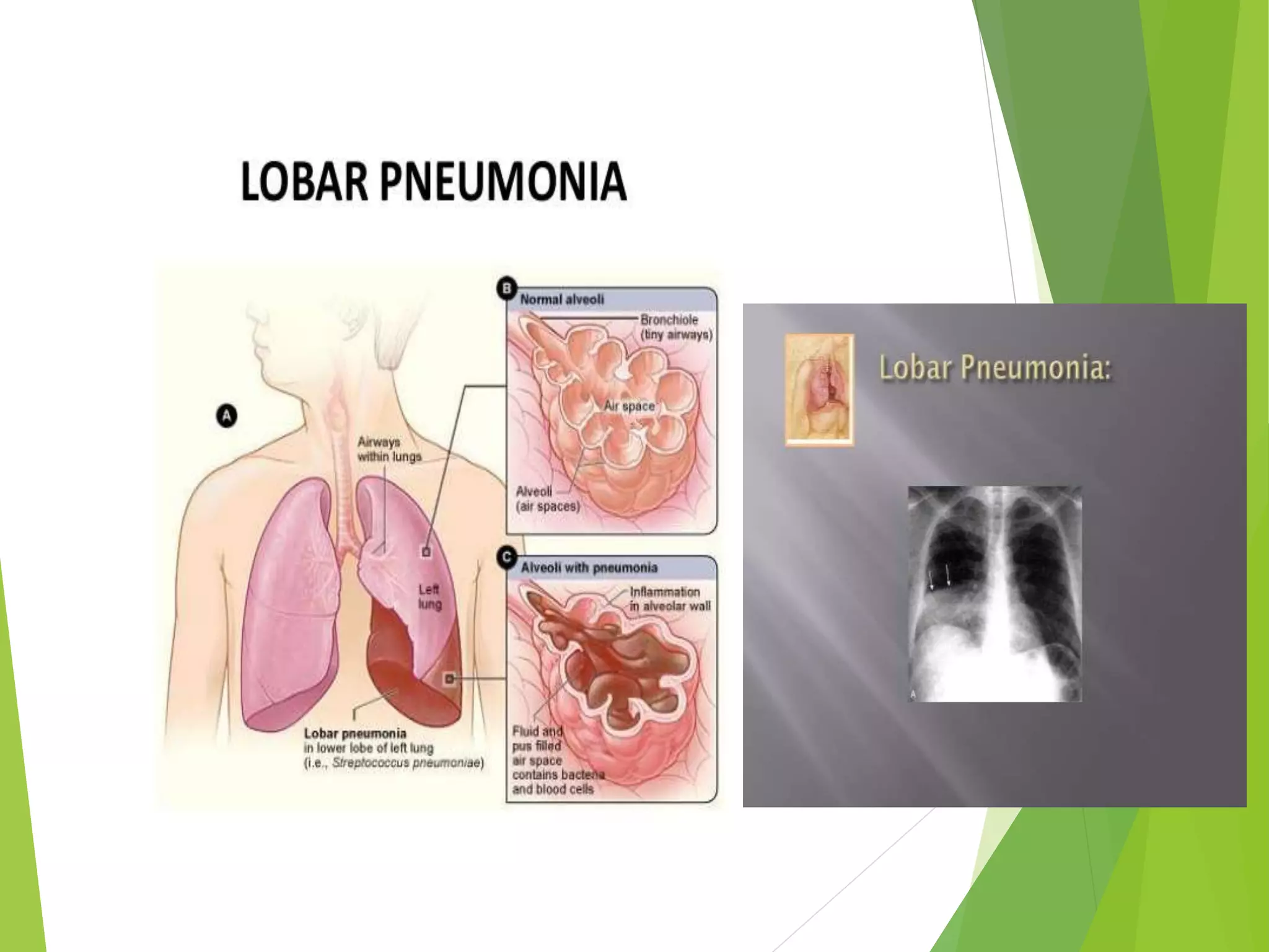 Pneumonia | PPTX