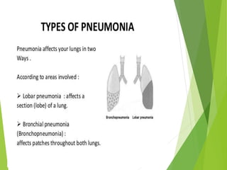 Pneumonia | PPTX