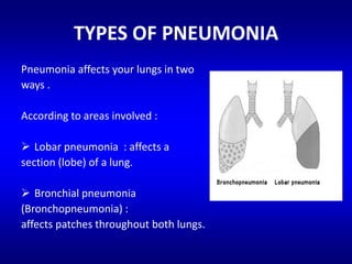 Pneumonia | PDF