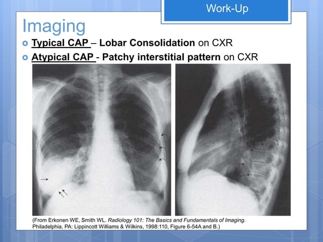 Diagnosis & Mangement of Community-Acquired Pneumonia, Hospital ...