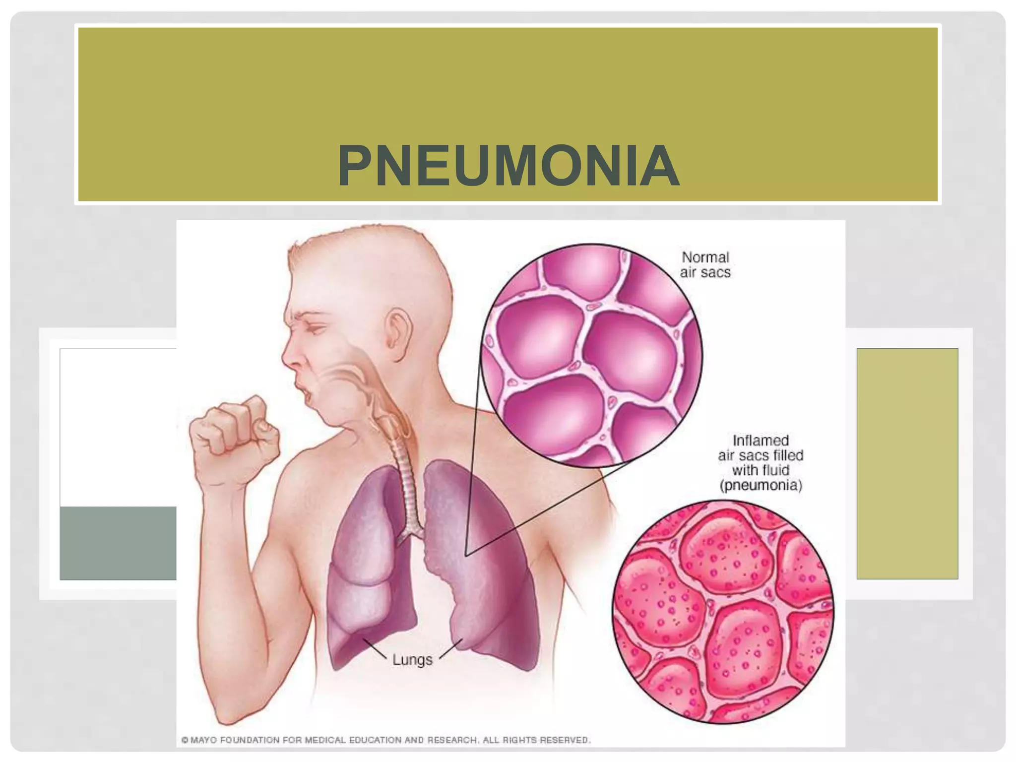 Pneumonia | PPTX