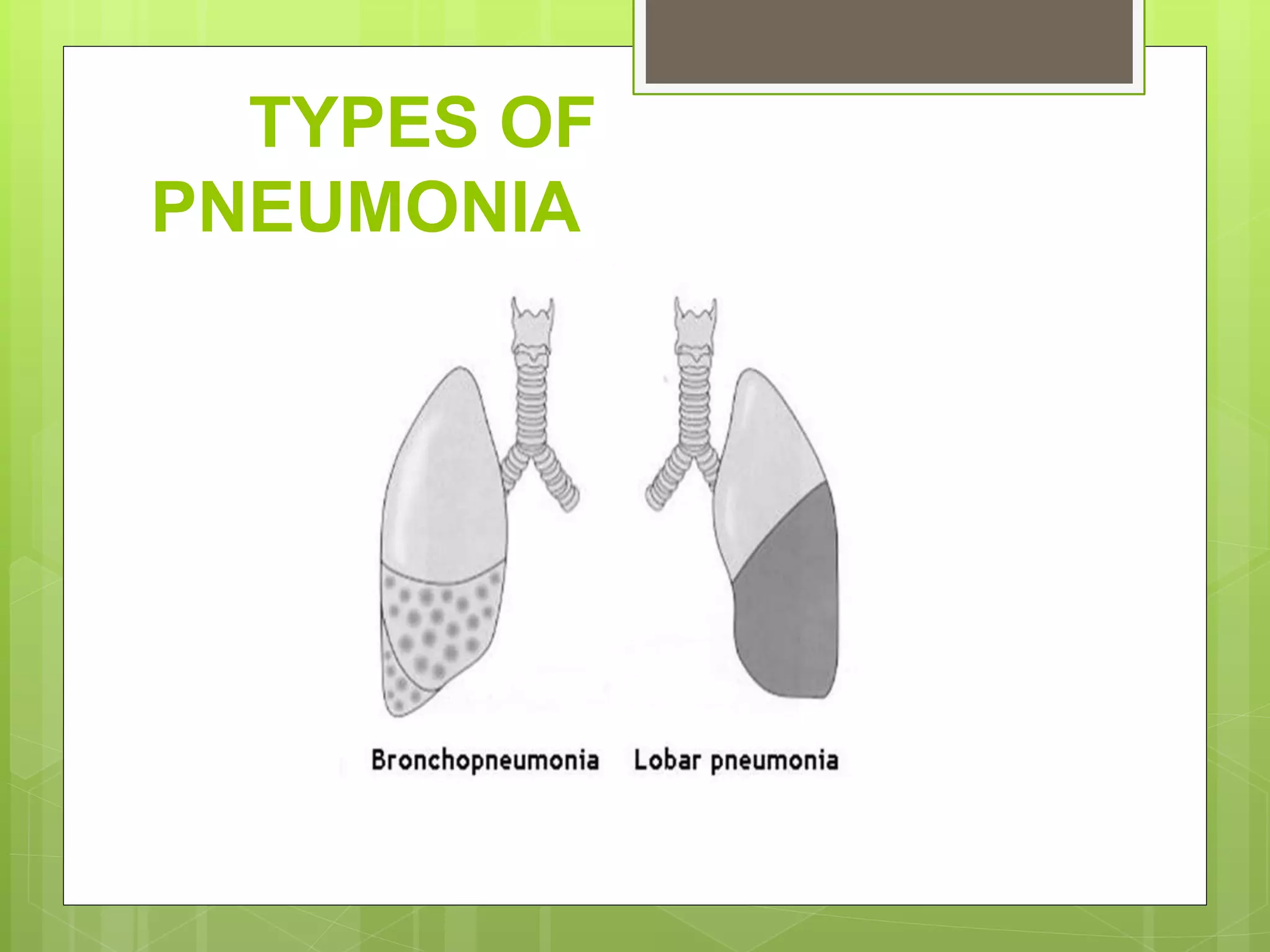 Pneumonia | PPTX