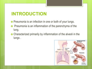 Pneumonia | PPTX