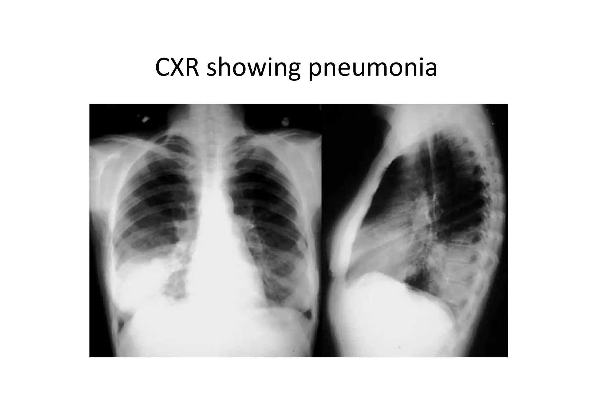 Pneumonia | PDF