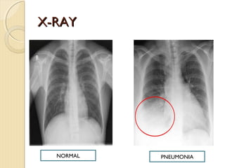 Lower respiratory tract infection Pneumonia | PPT