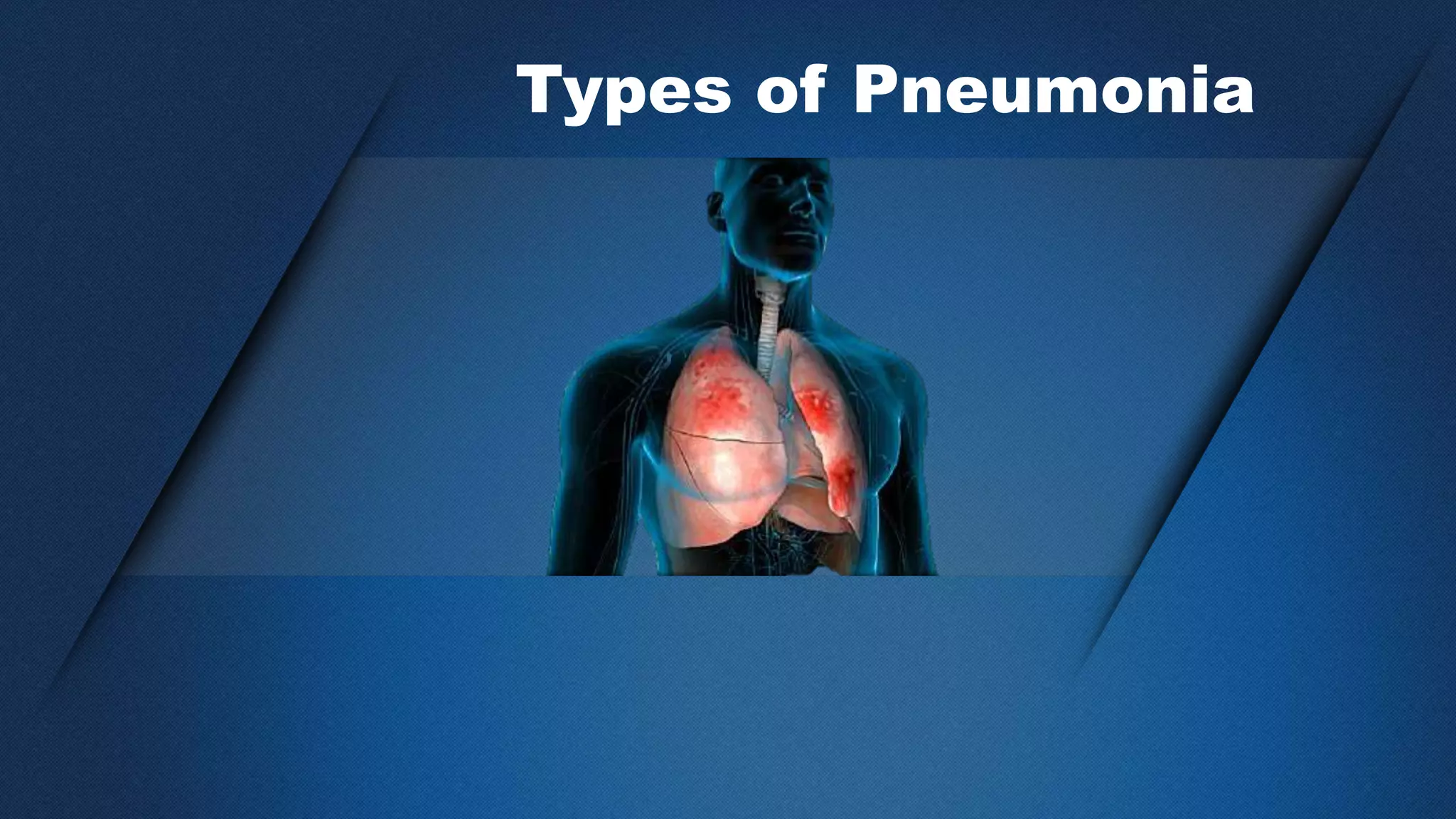 Pneumonia | PPTX