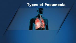 Pneumonia | PPTX