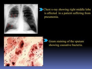 Pneumonia | PPT