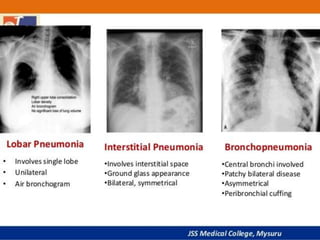 Bronchopneumonia Vs Lobar Pneumonia