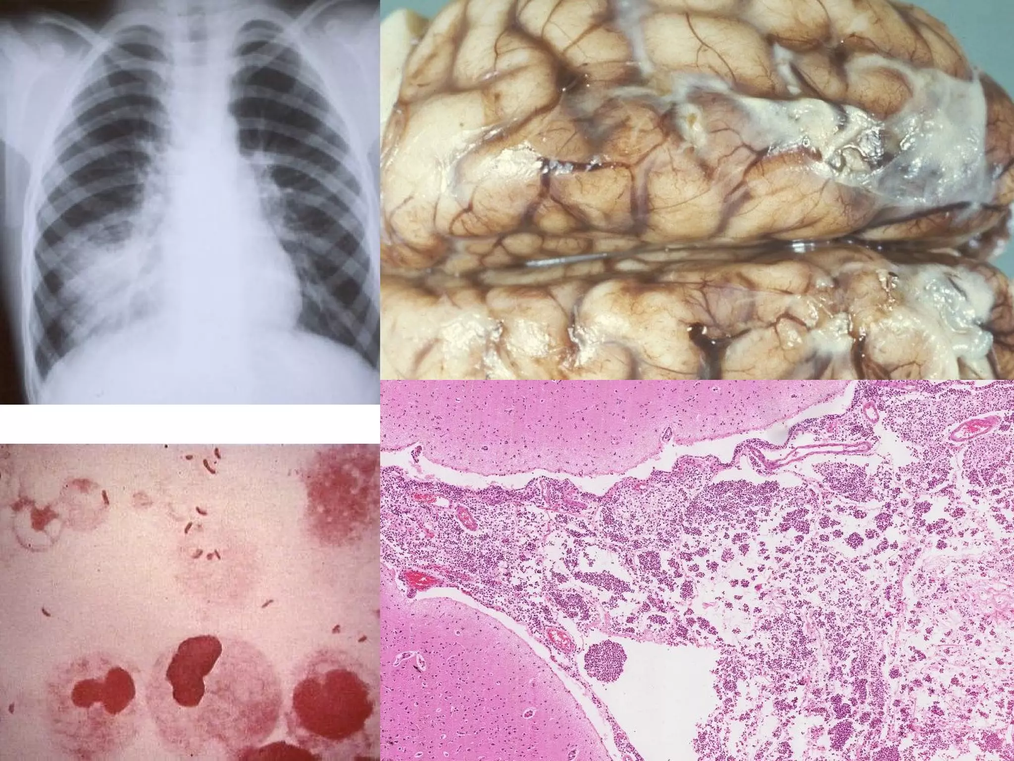 Pneumonia - Classification & Etiology | PPT