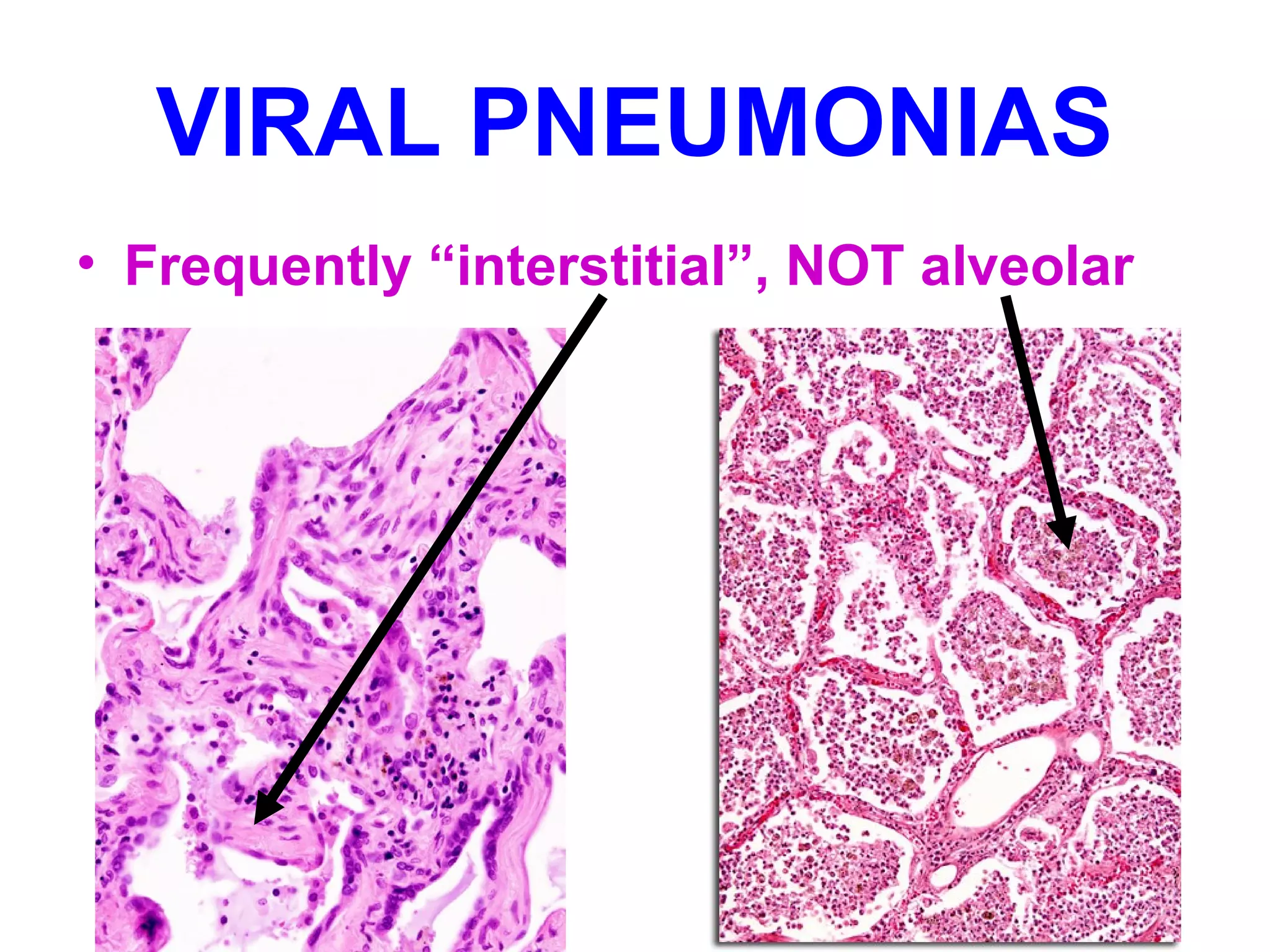 Pneumonia - Classification & Etiology | PPT