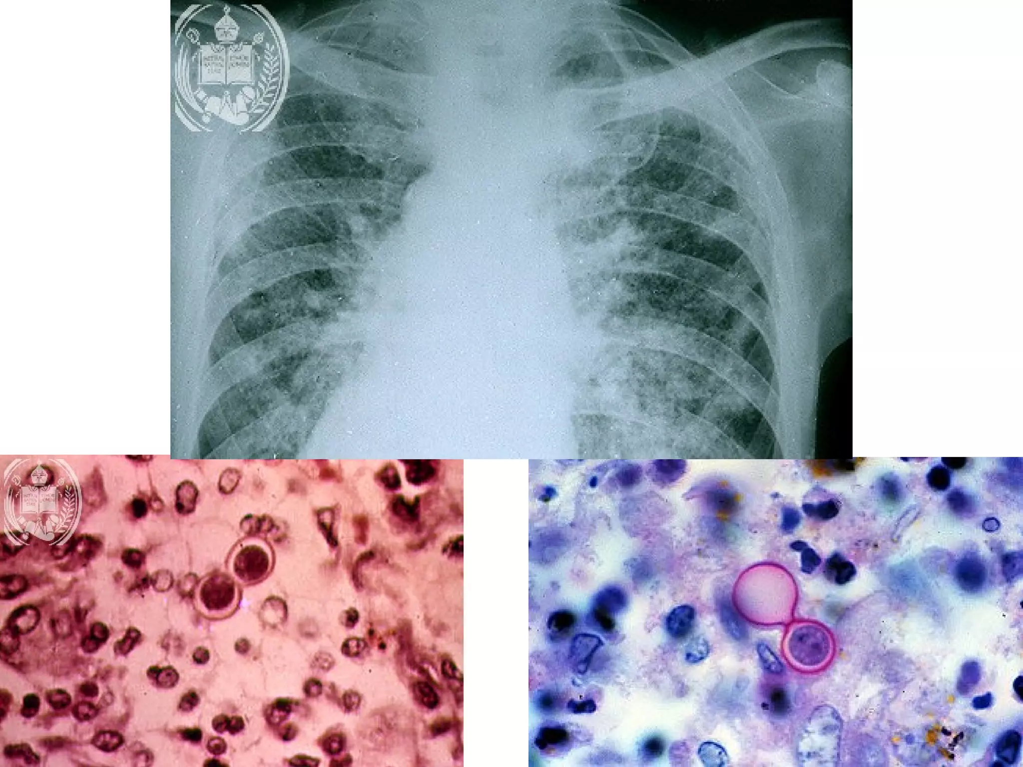 Pneumonia - Classification & Etiology | PPT