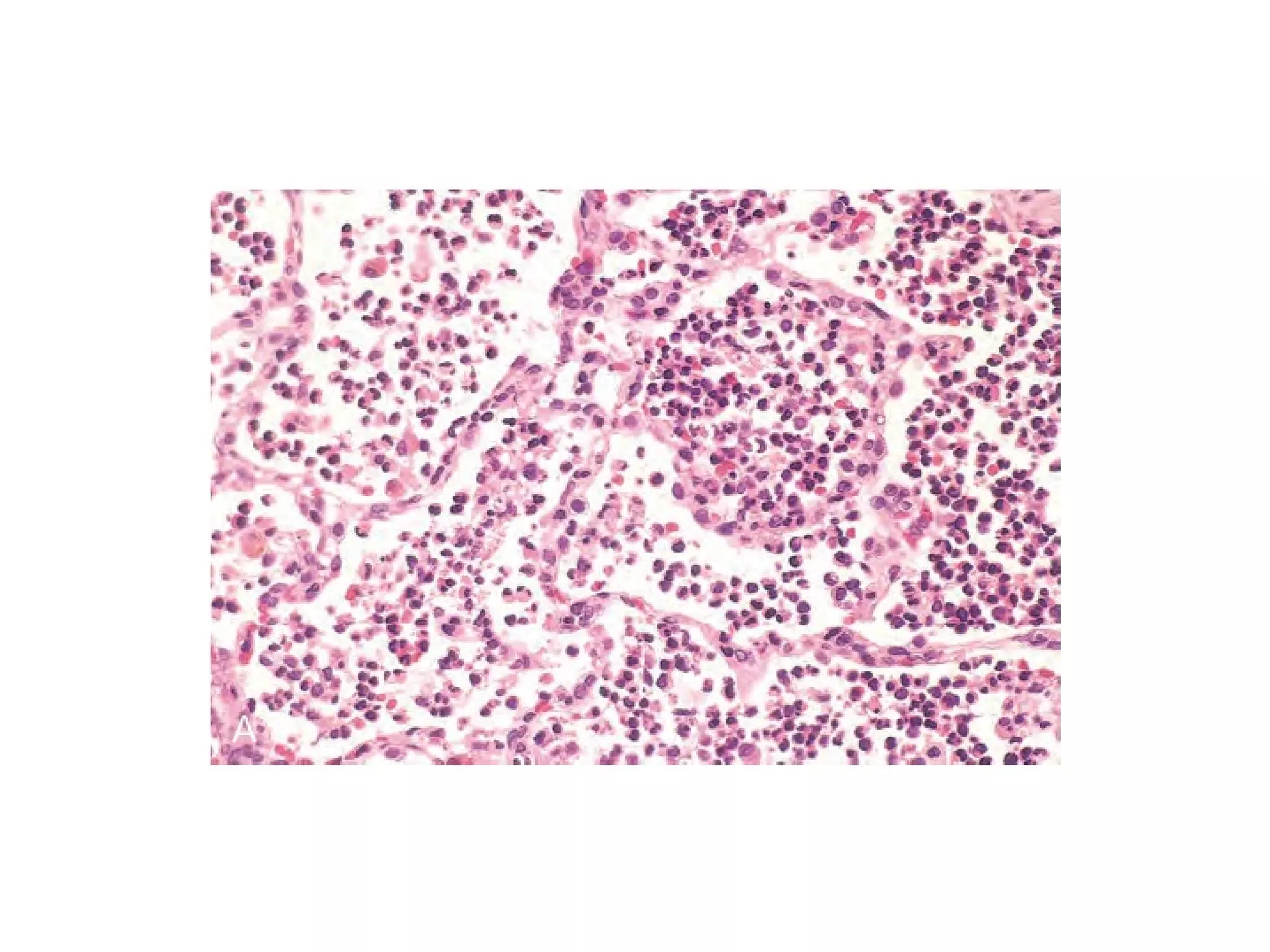 Pneumonia - Classification & Etiology | PPT