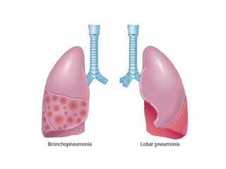 Pneumonia - Classification & Etiology | PPT