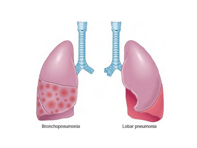 Pneumonia - Classification & Etiology | PPT