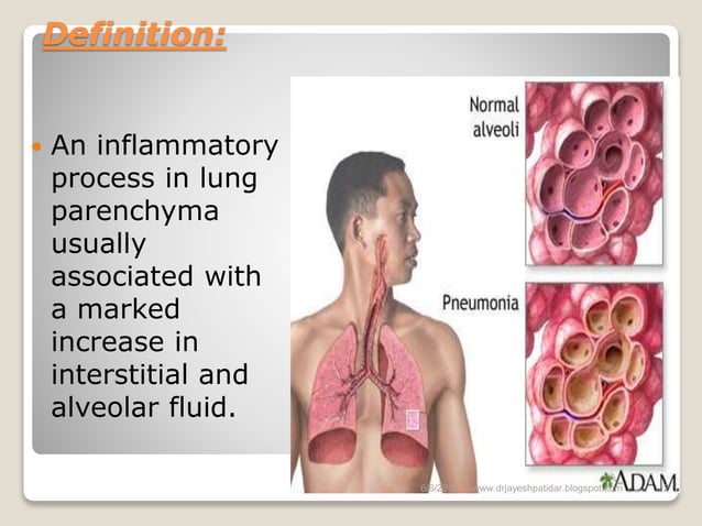 Pneumonia | PPSX | Lung and Respiratory Health | Diseases and Conditions