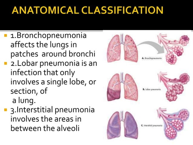 Pneumonia | PPT