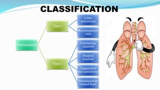 PNEUMONIA | PPTX