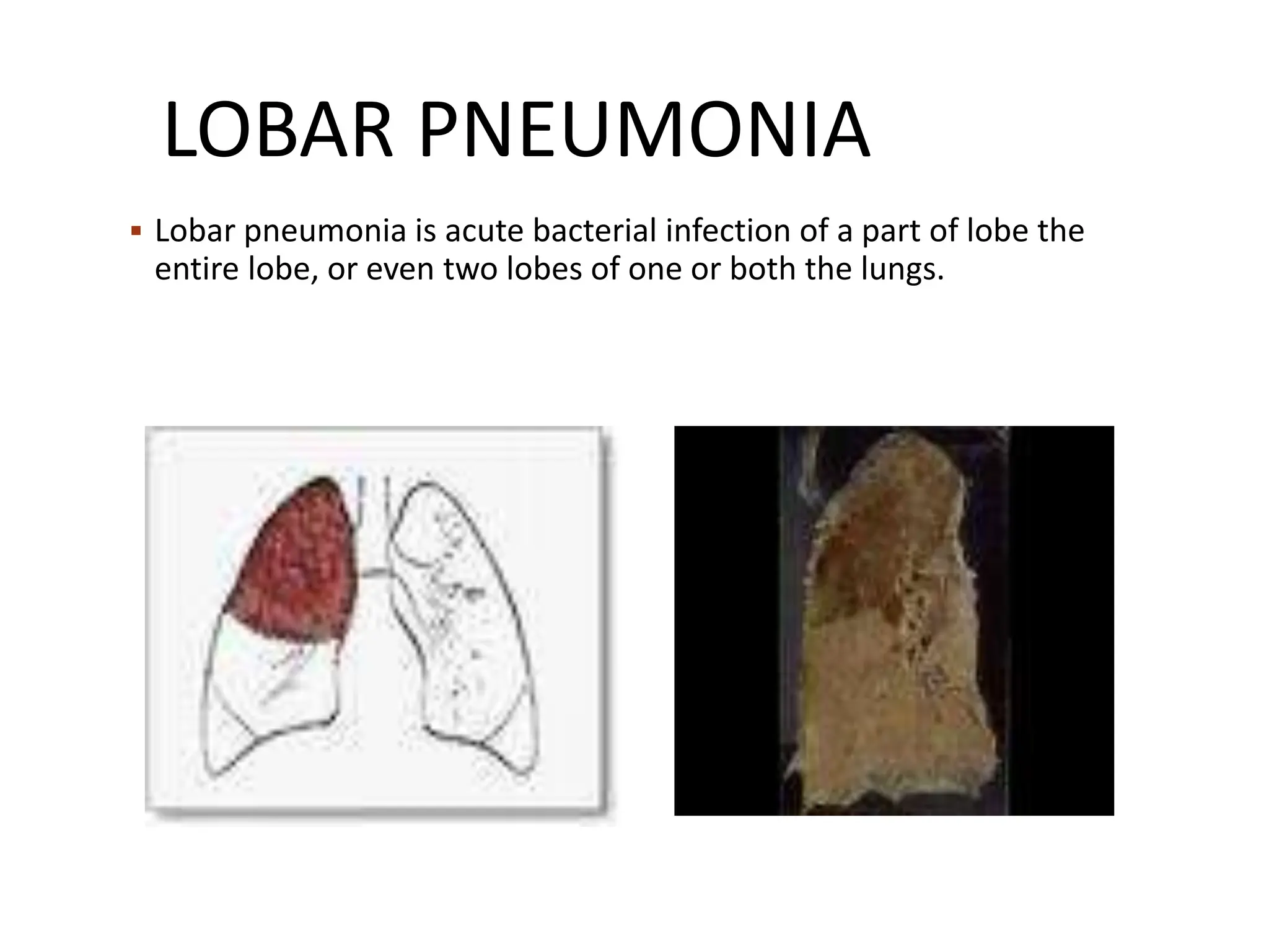 pneumonia-190706120001.pptx. . | PPTX