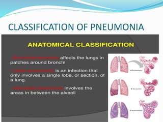 PNEUMONIA-2.pptx