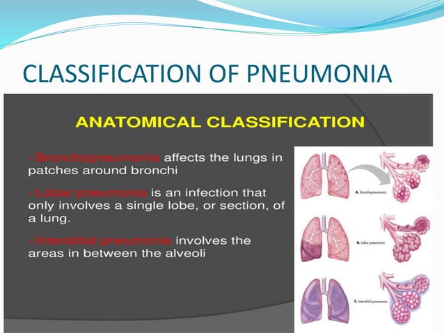 PNEUMONIA-2.pptx