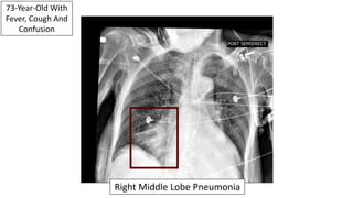 EMGuideWire's Radiology Reading Room: Pneumonia | PPTX