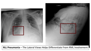 EMGuideWire's Radiology Reading Room: Pneumonia | PPTX