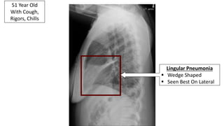 EMGuideWire's Radiology Reading Room: Pneumonia | PPTX