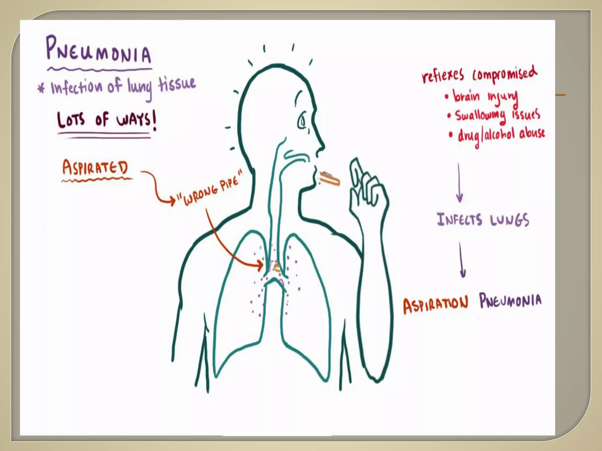 Pneumonia | PPTX