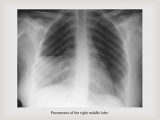 Pneumonia | PPTX