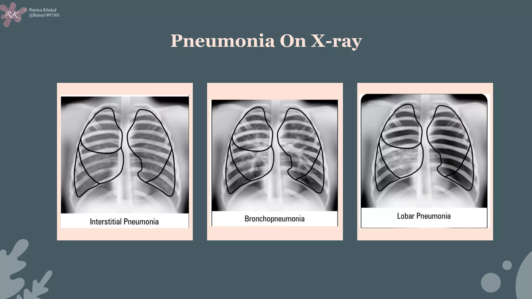 Pneumonia | PPT