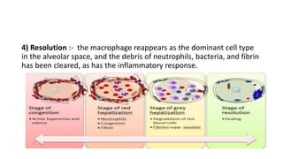 Pneumonia | PPTX