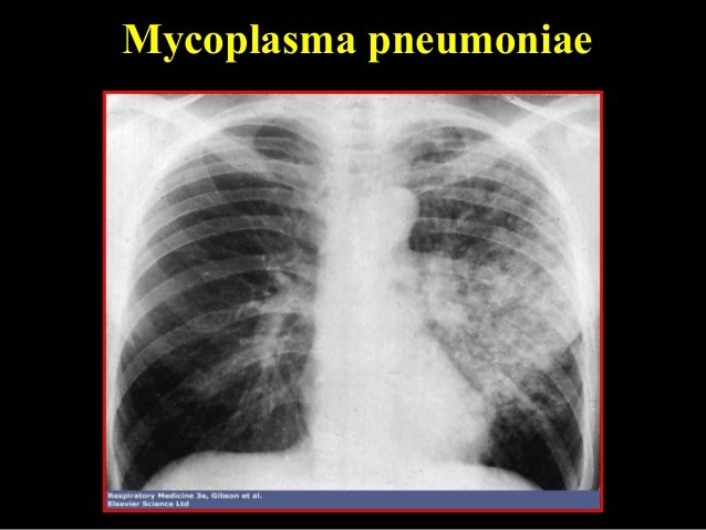 Mycoplasma Pneumoniae X Ray CDC X Ray Image: Mycoplasm Pneumonia