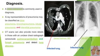 Pneumonia | PPT