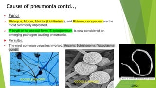 Pneumonia | PPT