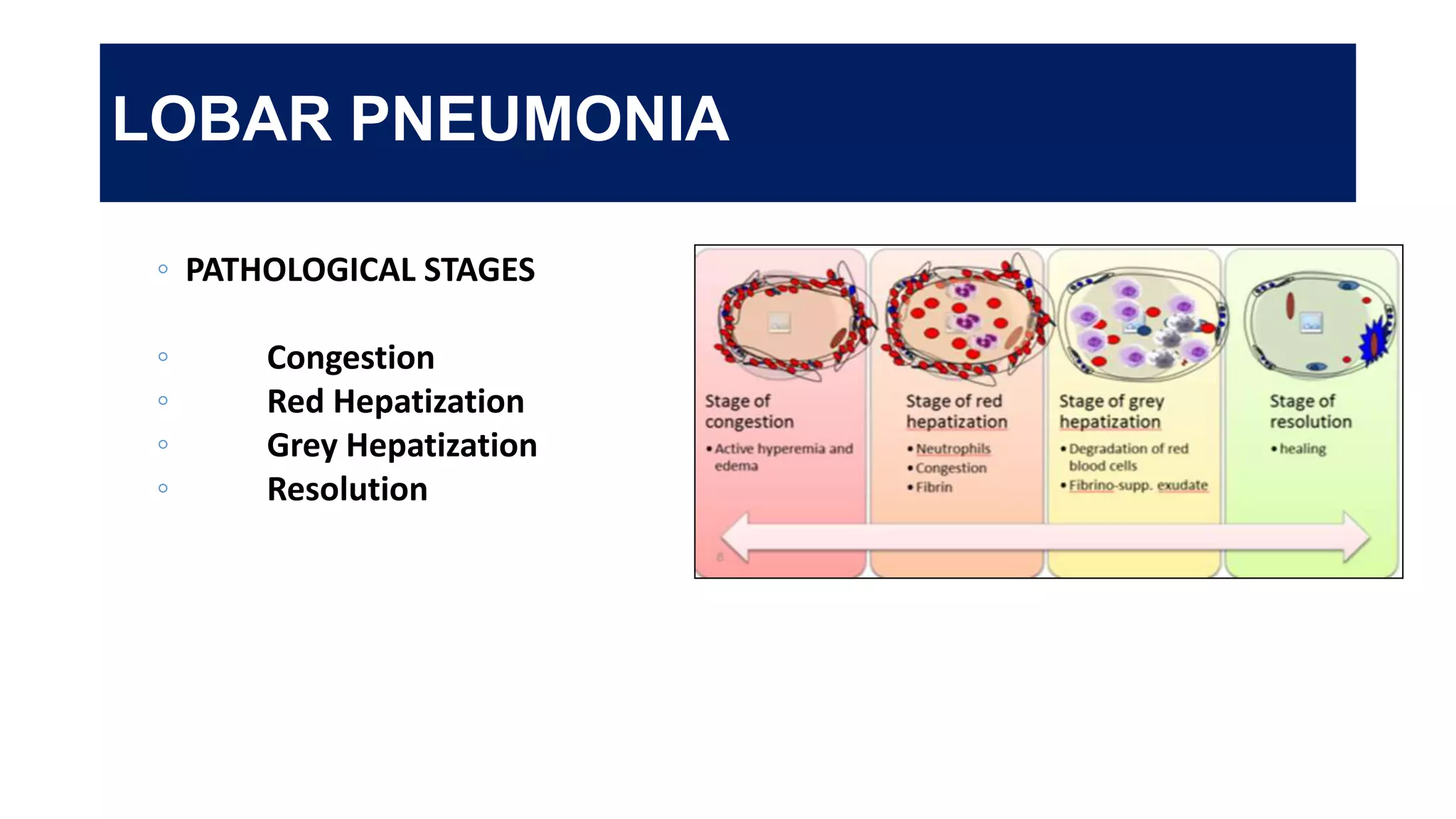 Pneumonia ppt | PPTX
