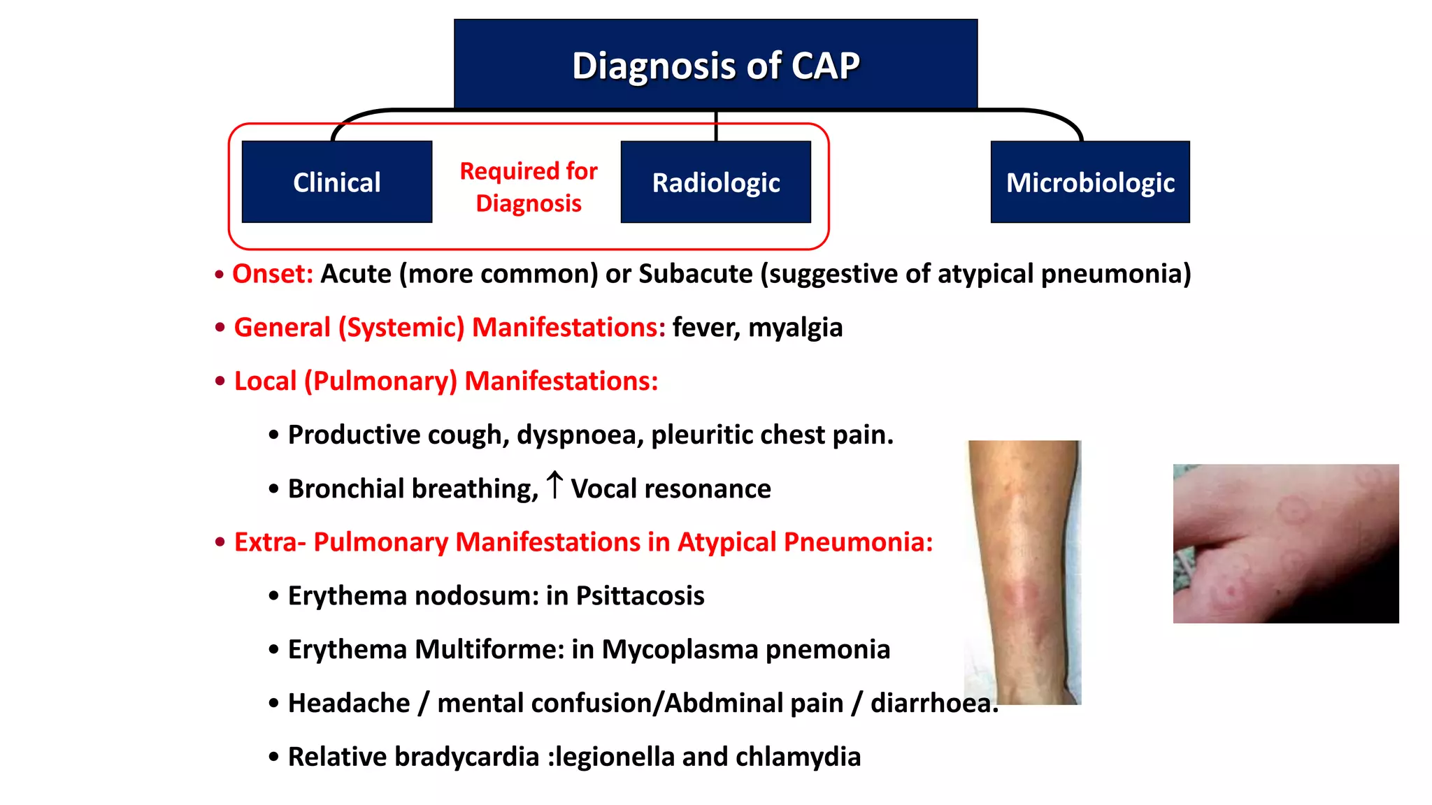 Pneumonia ppt | PPTX