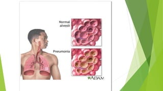 Pneumonia.pptx