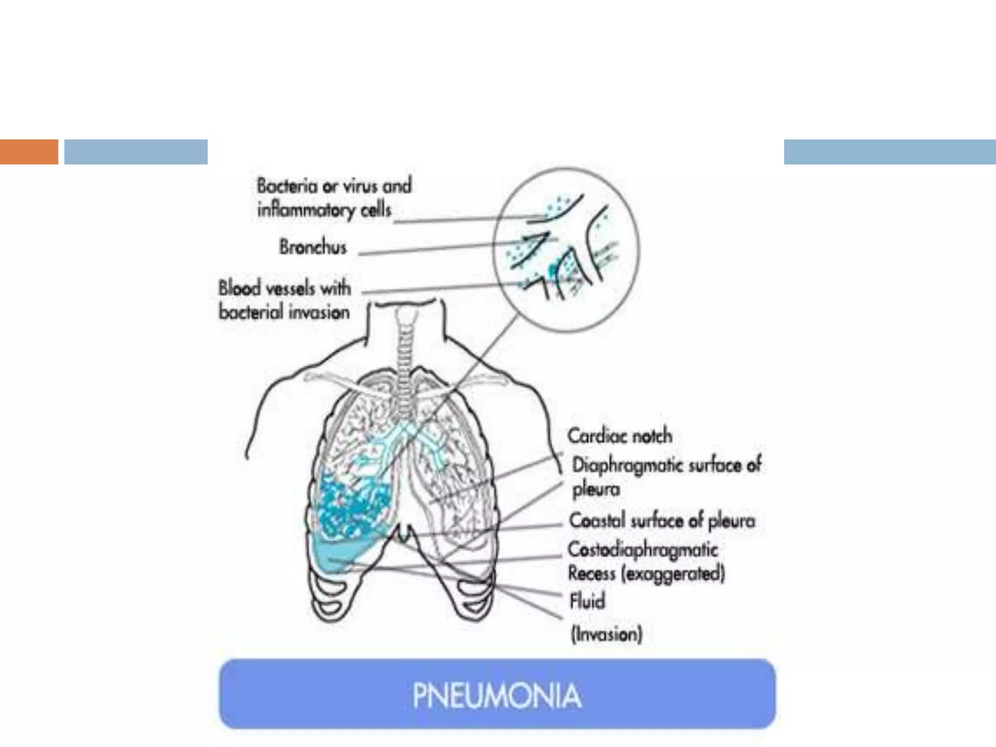 Pneumonia_.ppt