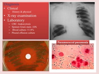 Pneumonia-.pptx