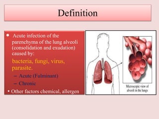 Pneumonia-.pptx